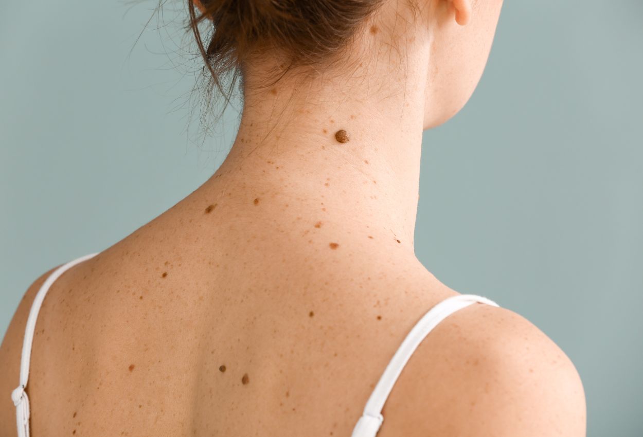 Melanoma Todo Lo Que Debes Saber Sobre Este Cáncer De Piel Ecomedic